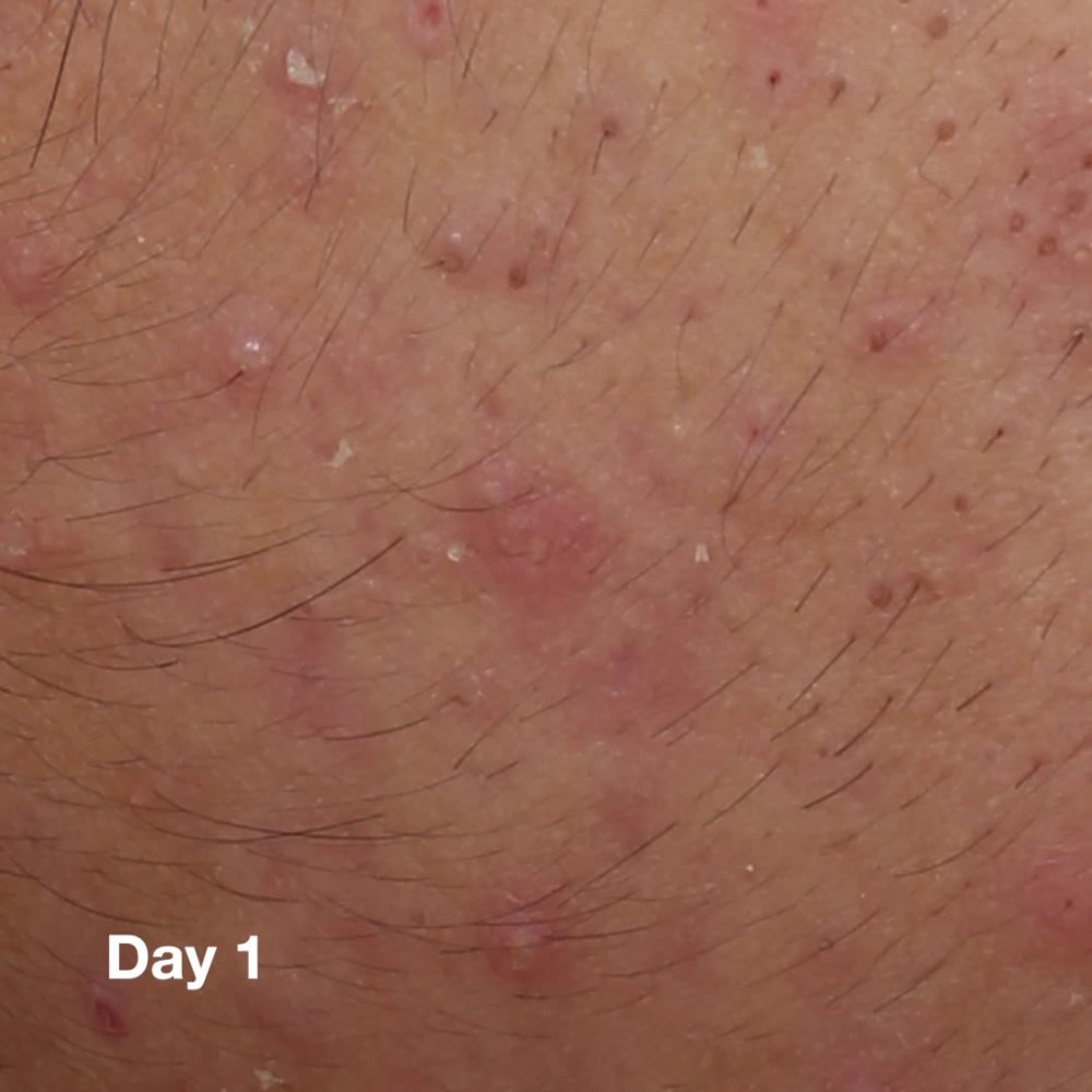 Neutrogena Stubborn Acne Spot Drying Acne Treatment, 10% Sulfur, 1 oz ...